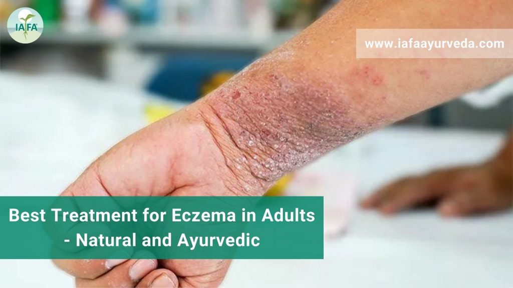 Best Treatment for Eczema in Adults - Natural and Ayurvedic